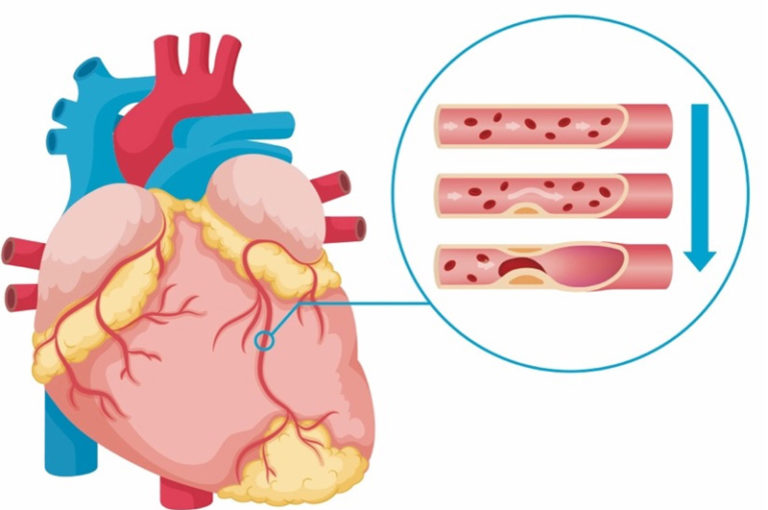 Ischemic Heart Disease - Detailed Pathology - 聖路加国際病院 心血管センター