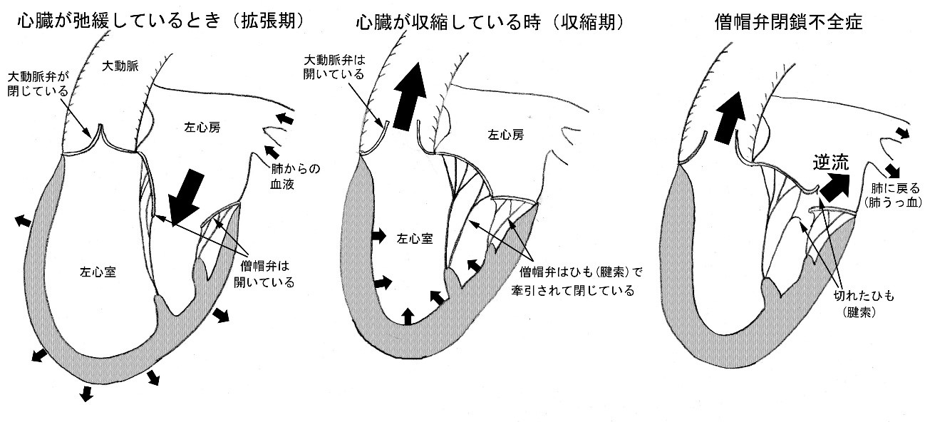 僧帽弁閉鎖不全症（MR） - 聖路加国際病院 心血管センター