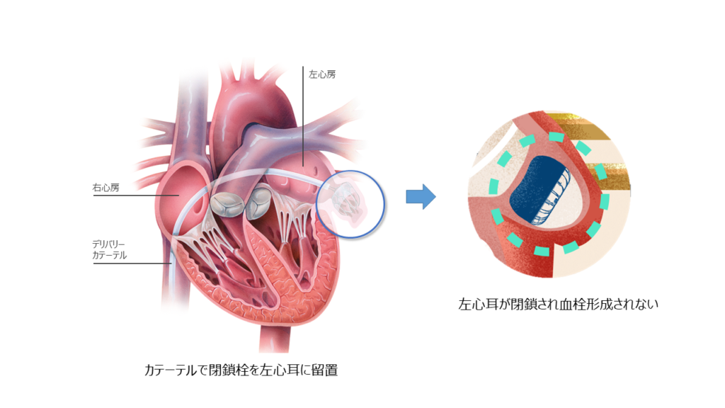 WATCHMAN - 聖路加国際病院 心血管センター