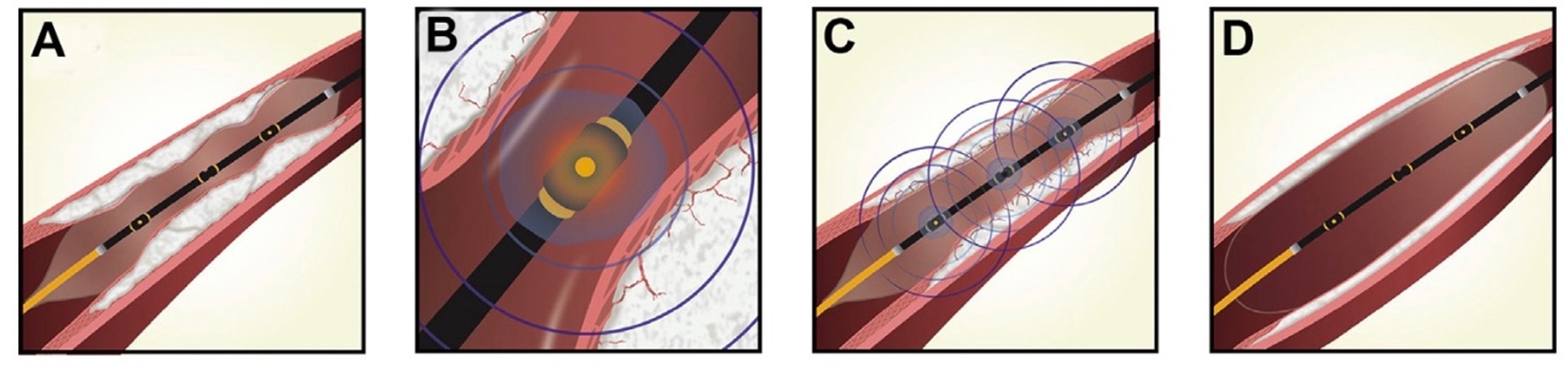 Shockwave (IVL) for Safe Treatment of Heavily Calcified Lesions - 聖路加国際 ...